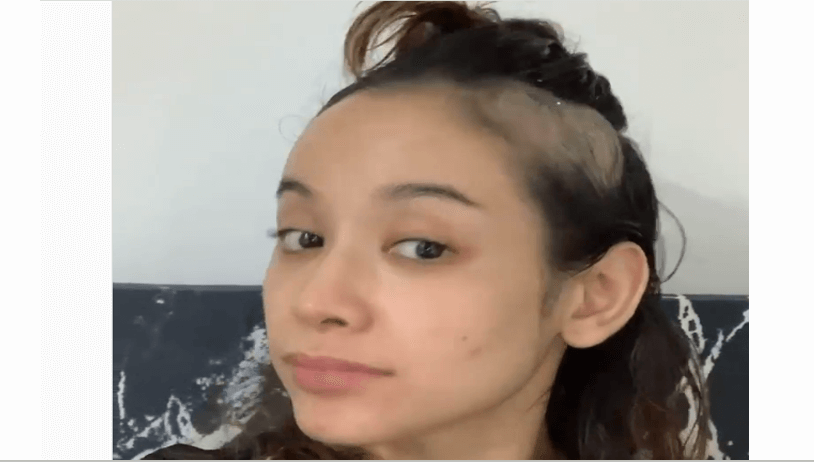 Bea Benedicto reveals she has alopecia | PLN Media